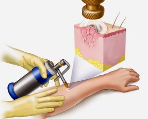 Electrocautery and Cryotherapy – Allure