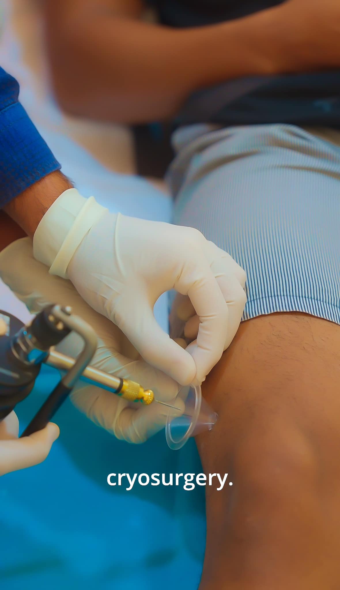 Cryosurgery: A Safe and Effective Solution for Skin Conditions at Allure Laser, Skin & Aesthetic ...